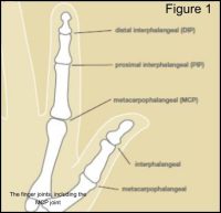 Metacarpophalangeal Joint Arthritis | DFW Hand Surgeon