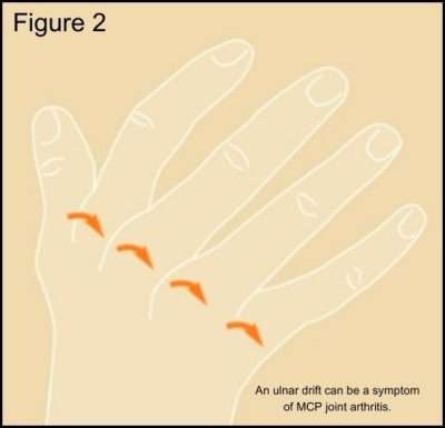 Metacarpophalangeal Joint Arthritis | DFW Hand Surgeon