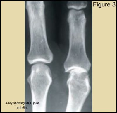 Metacarpophalangeal Joint Arthritis | DFW Hand Surgeon