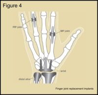 Metacarpophalangeal Joint Arthritis | DFW Hand Surgeon