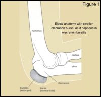 Olecranon Bursitis: Elbow Bursitis | DFW Hand Surgeon