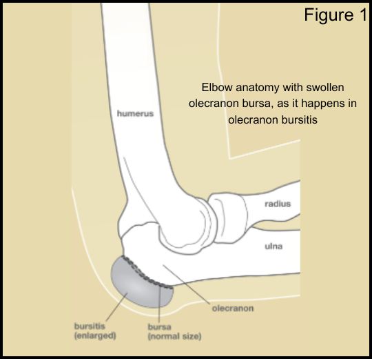 Olecranon Bursitis Elbow Bursitis DFW Hand Surgeon Olecranon Bursitis Elbow Bursitis DFW Hand Surgeon