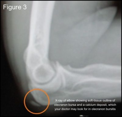 Olecranon Bursitis: Elbow Bursitis | DFW Hand Surgeon